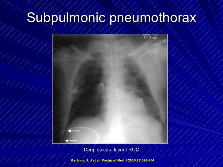 Chest radiology in intensive care
