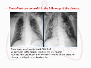 Chest radiology of covid 19 | PPTX