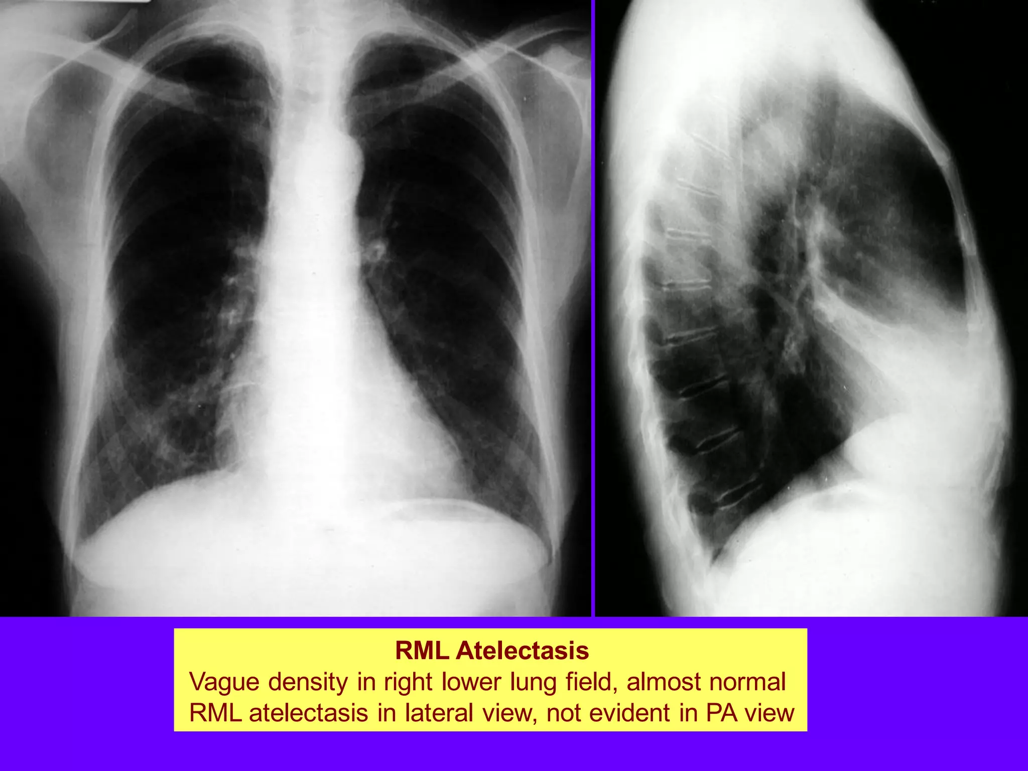 Chest radiology part 1 | PDF