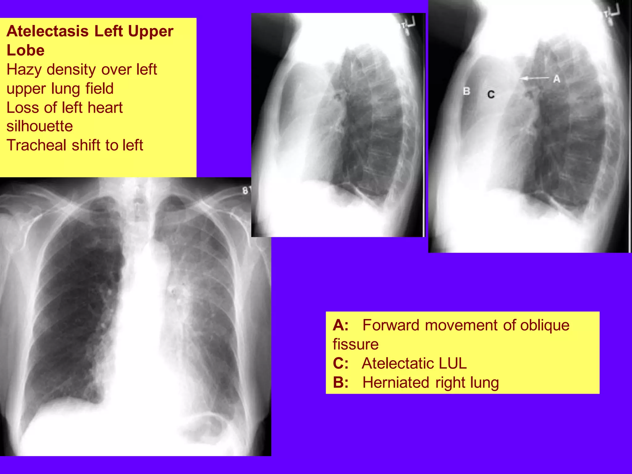 Chest radiology part 1 | PDF