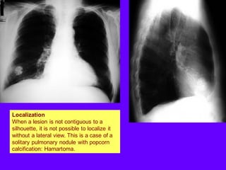 Chest radiology part 1 | PDF