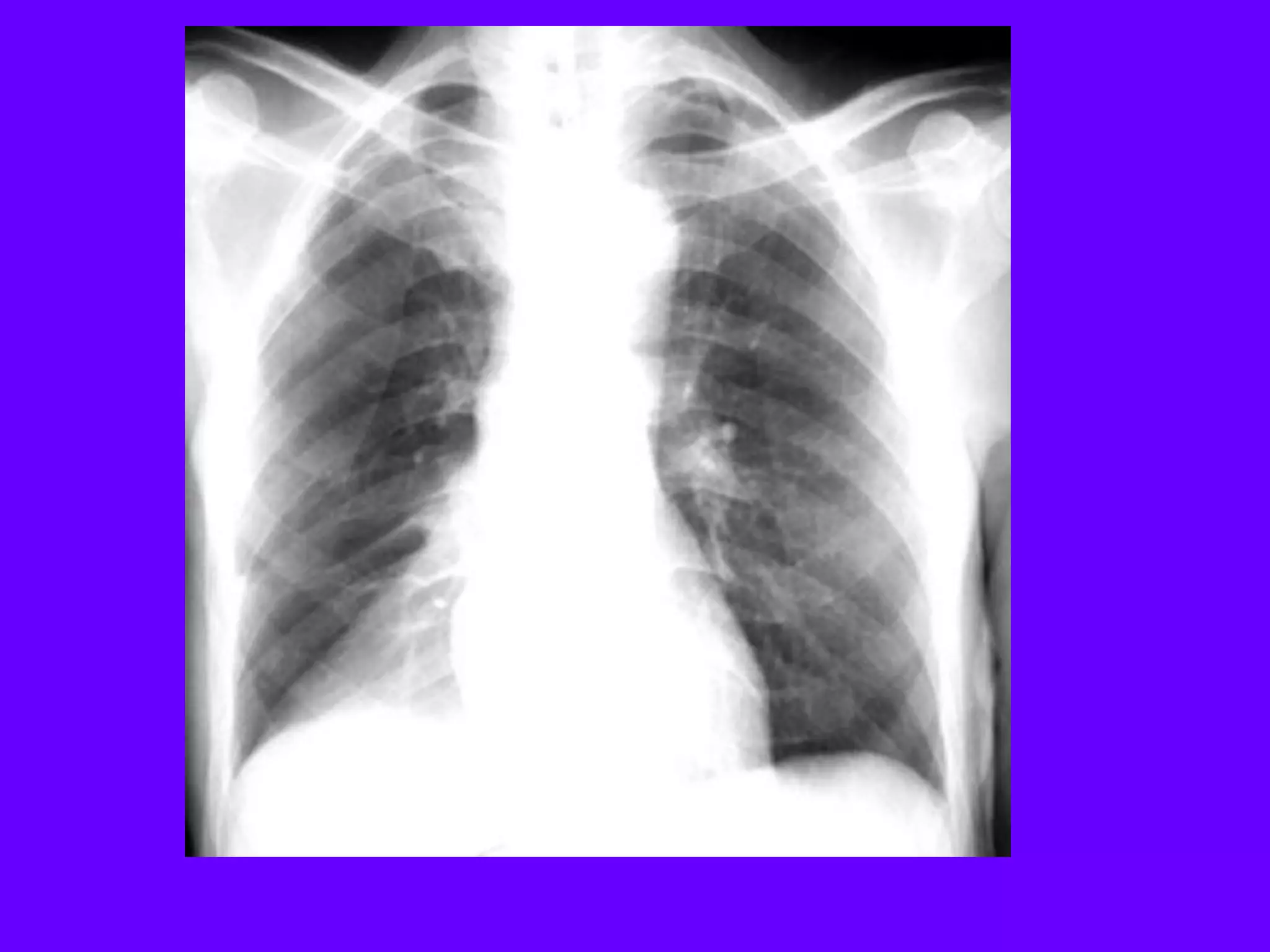 Chest radiology part 2 | PPT