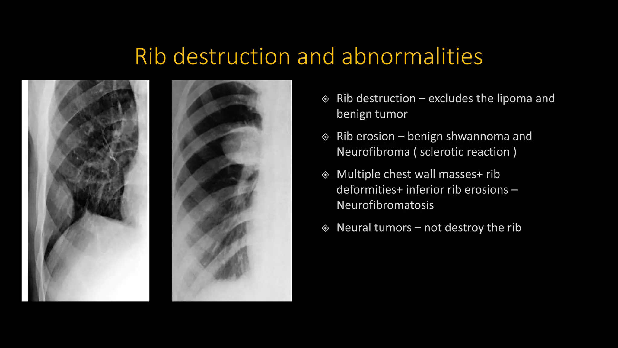 Chest radiology pattern and differential diagnosis ( chest wall and ...