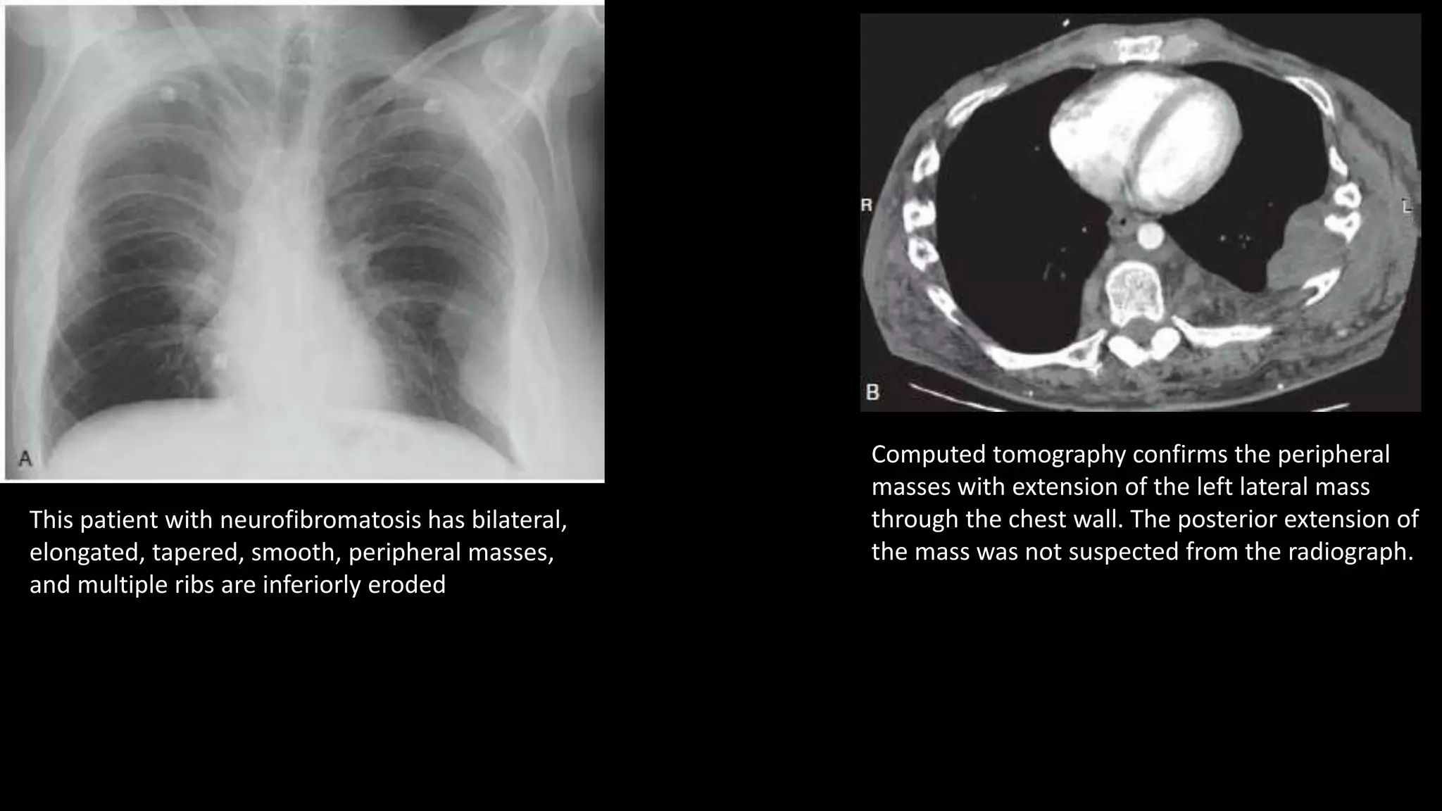 Chest radiology pattern and differential diagnosis ( chest wall and ...