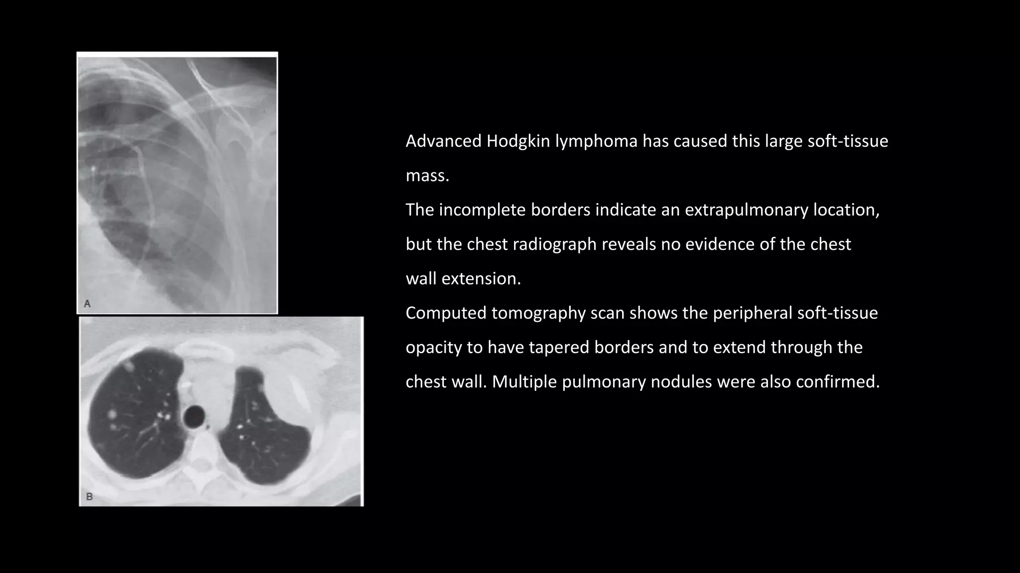 Chest radiology pattern and differential diagnosis ( chest wall and ...
