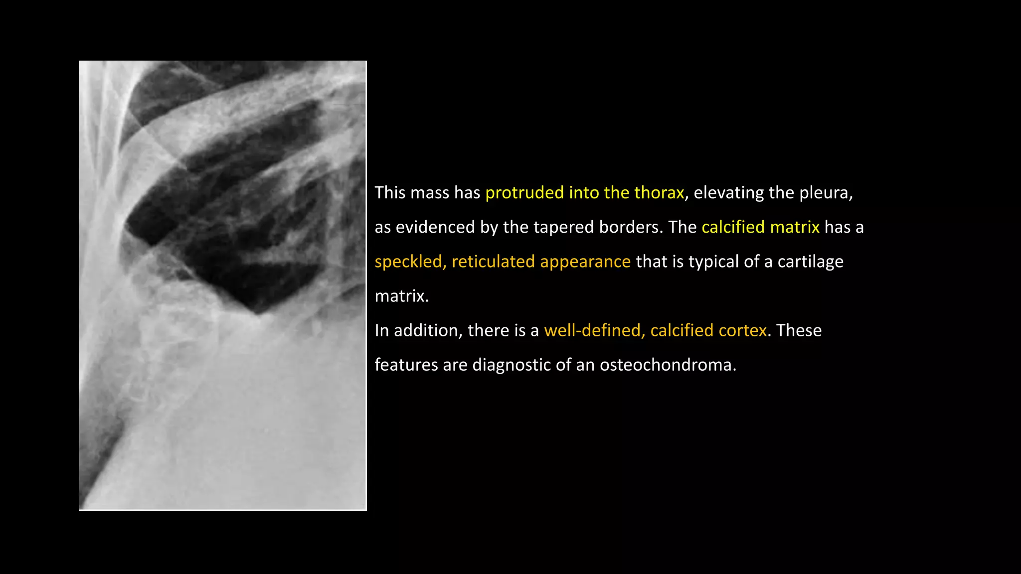 Chest radiology pattern and differential diagnosis ( chest wall and ...