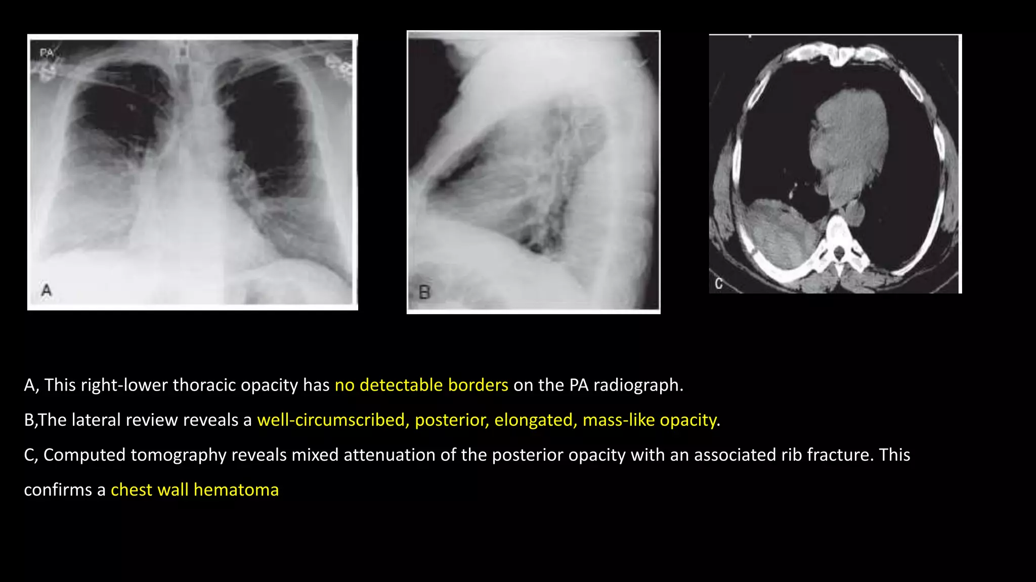 Chest radiology pattern and differential diagnosis ( chest wall and ...