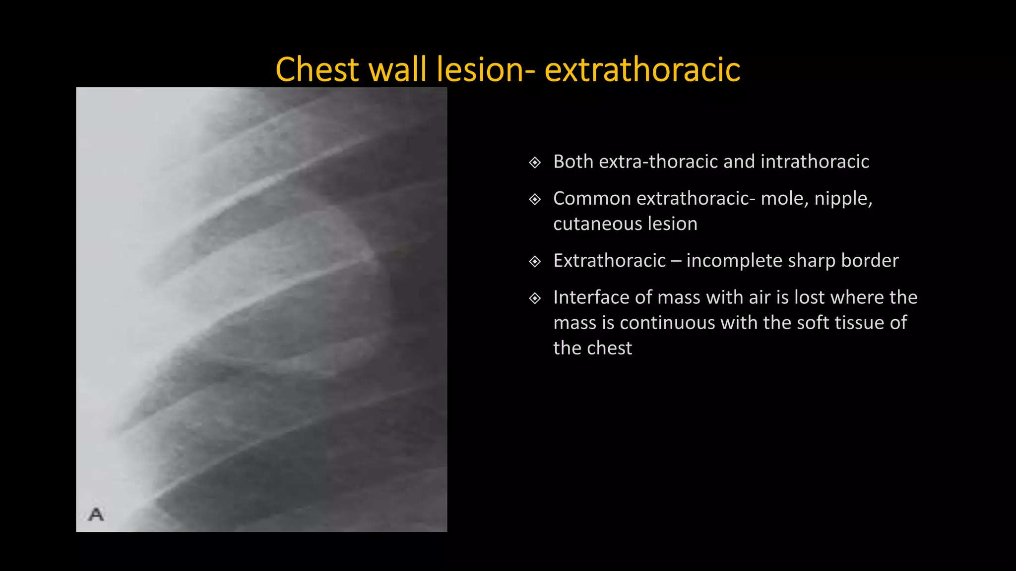Chest radiology pattern and differential diagnosis ( chest wall and ...