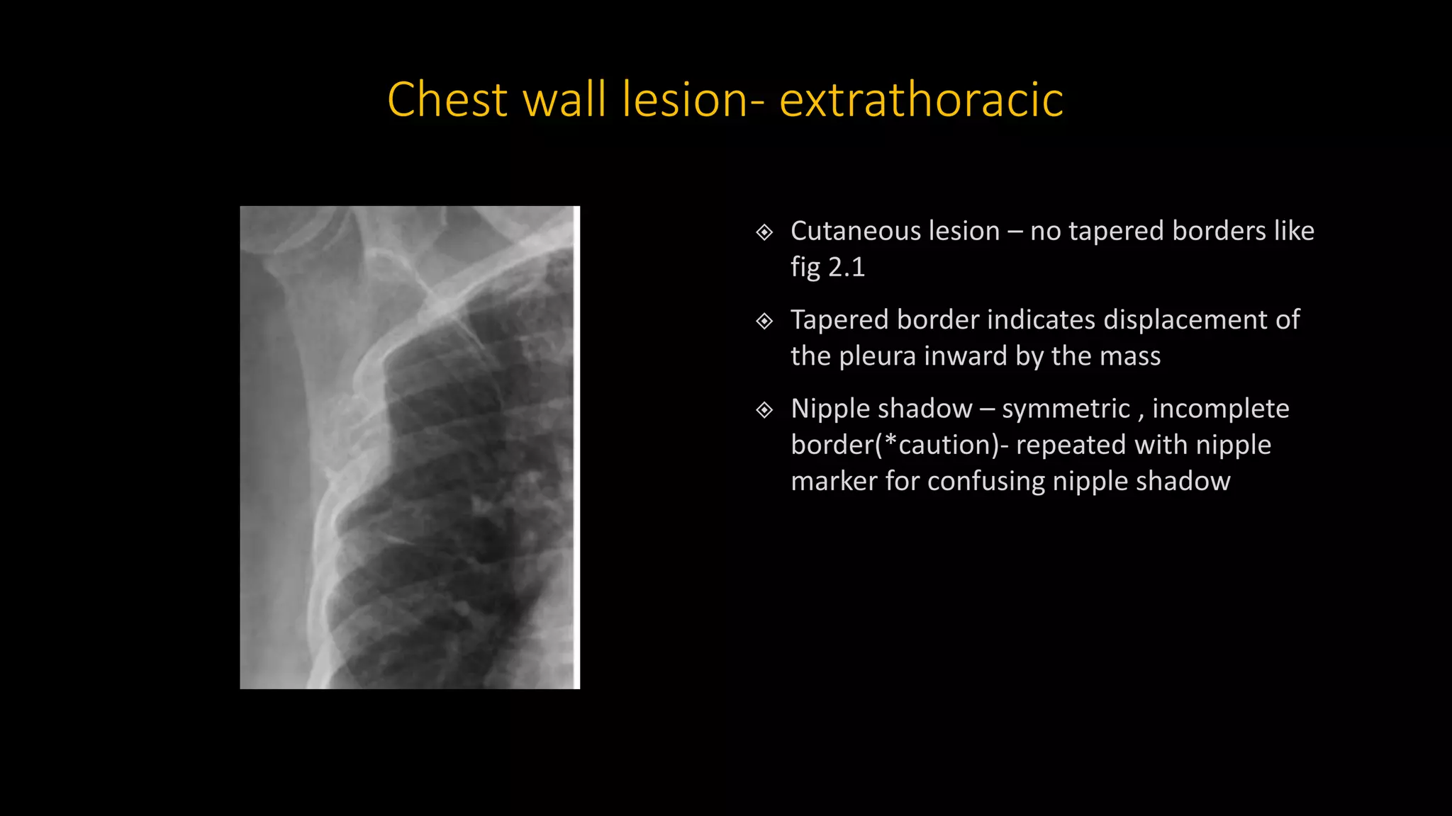 Chest radiology pattern and differential diagnosis ( chest wall and ...