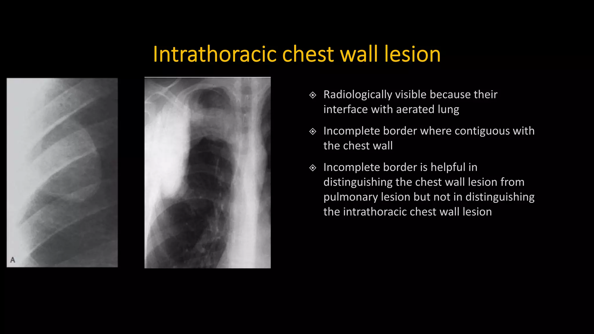Chest radiology pattern and differential diagnosis ( chest wall and ...