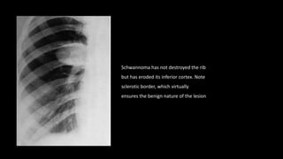 Chest radiology pattern and differential diagnosis ( chest wall and ...