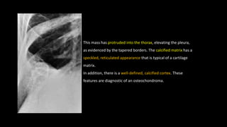 Chest radiology pattern and differential diagnosis ( chest wall and ...