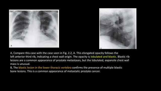 Chest radiology pattern and differential diagnosis ( chest wall and ...
