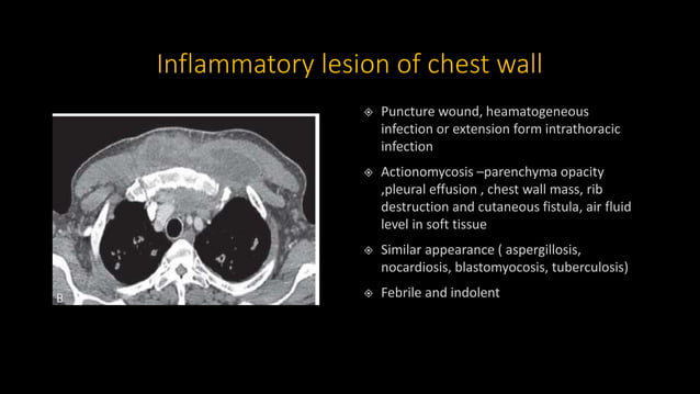 Chest radiology pattern and differential diagnosis ( chest wall and ...