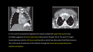 Chest radiology pattern and differential diagnosis ( chest wall and ...