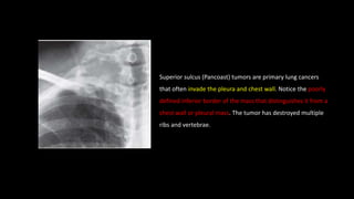 Chest radiology pattern and differential diagnosis ( chest wall and ...