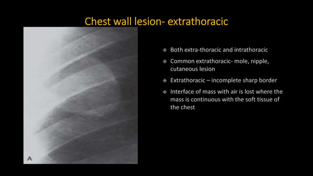 Chest radiology pattern and differential diagnosis ( chest wall and ...