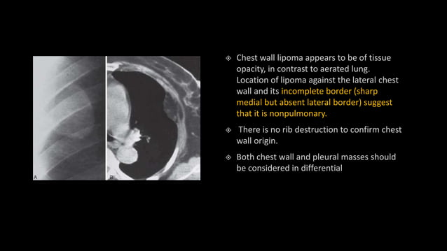 Chest radiology pattern and differential diagnosis ( chest wall and ...