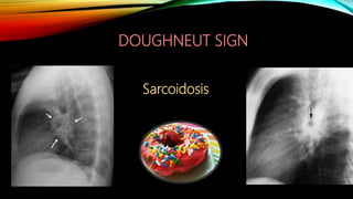 Chest signs | PPTX