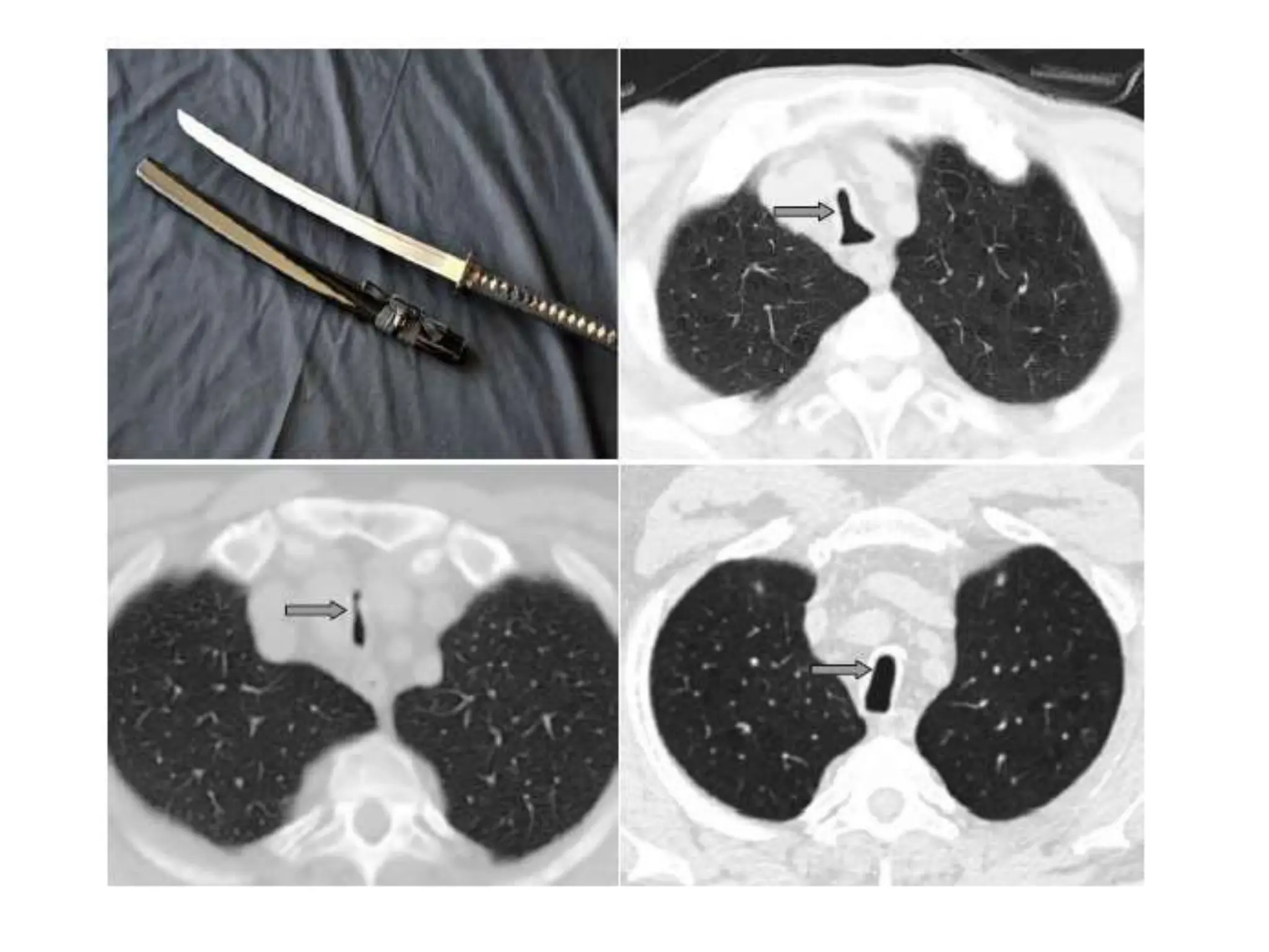 Chest signs spotters in xray andbct.pptx