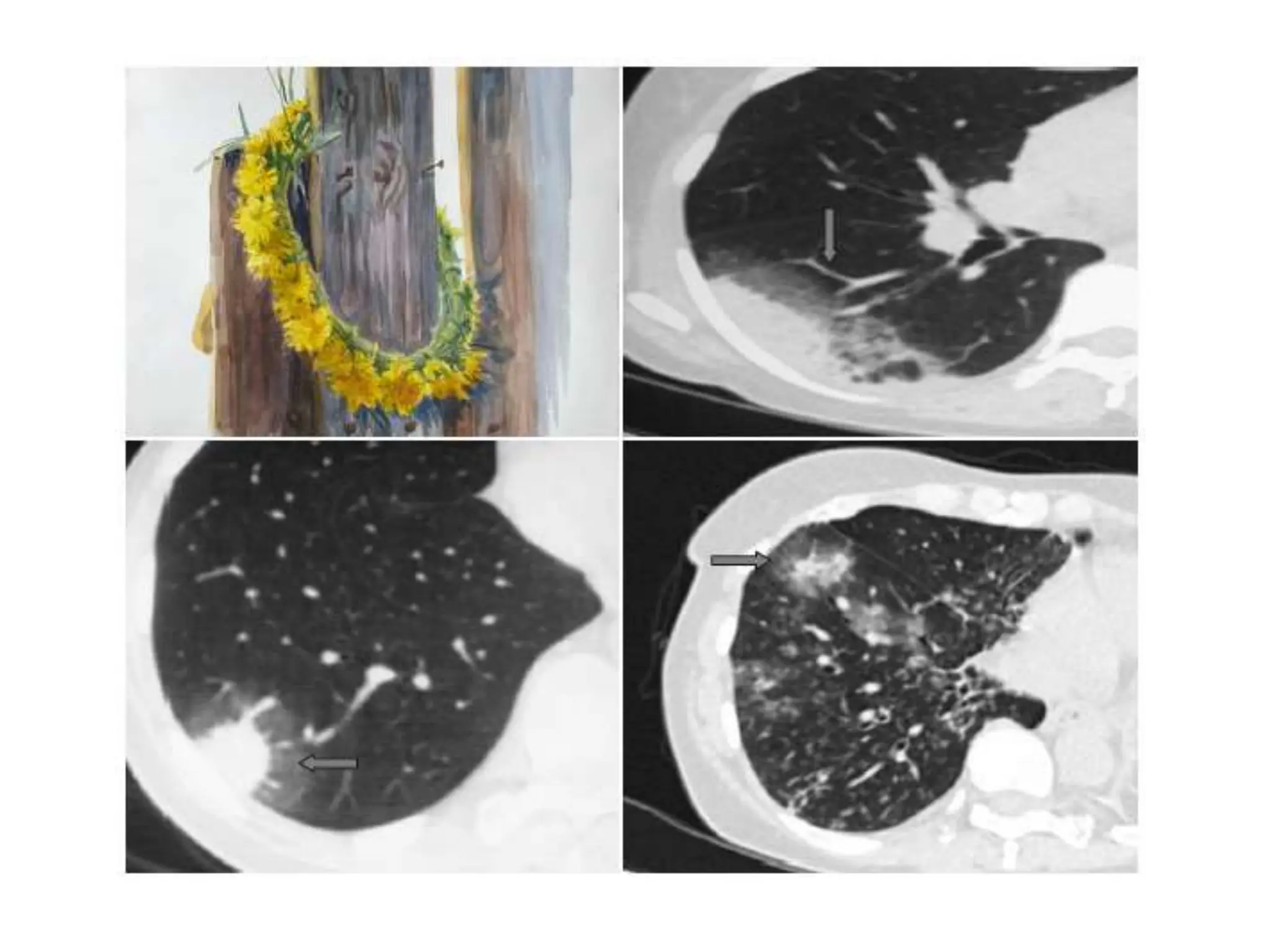 Chest signs spotters in xray andbct.pptx