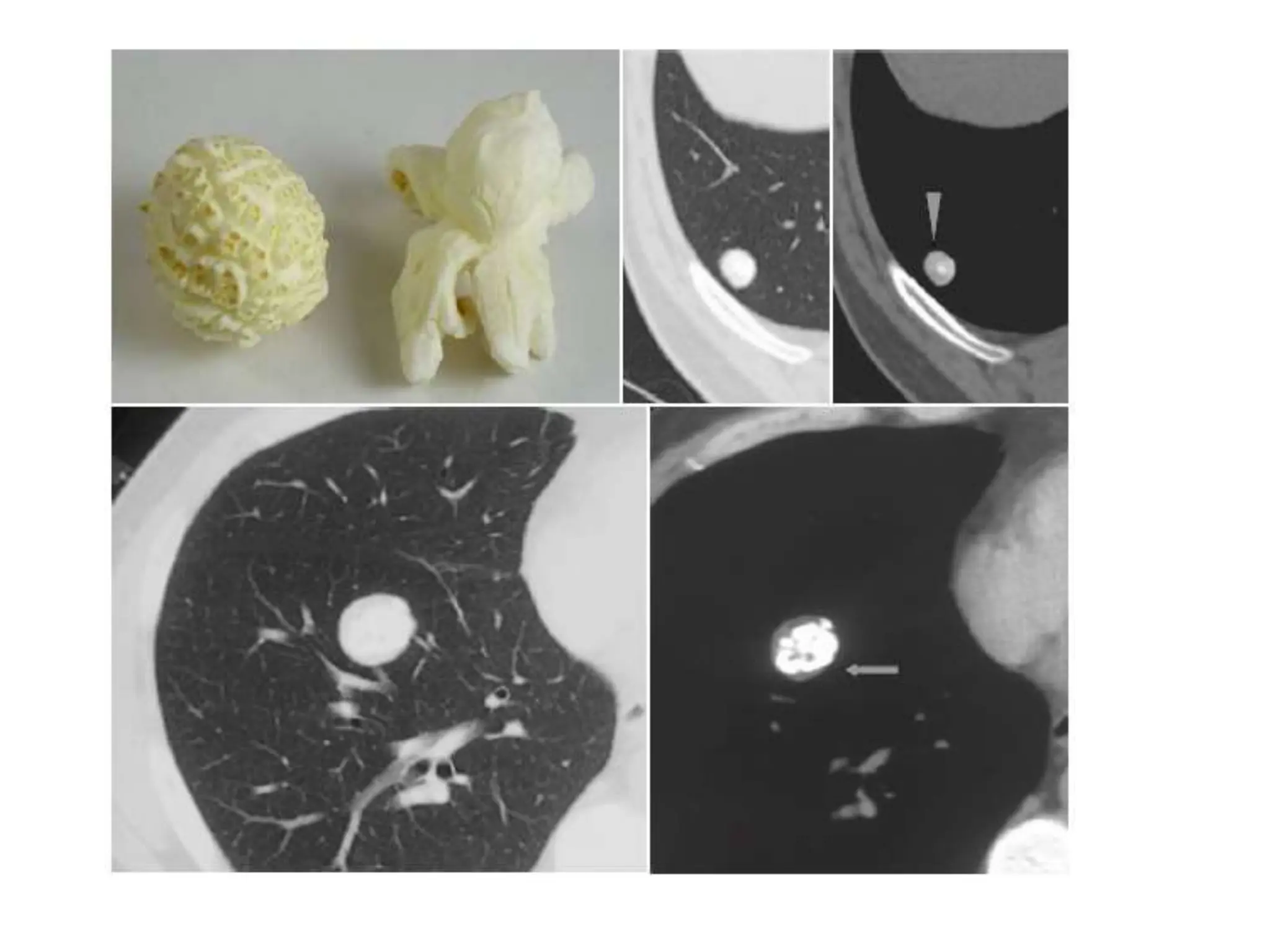 Chest signs spotters in xray andbct.pptx