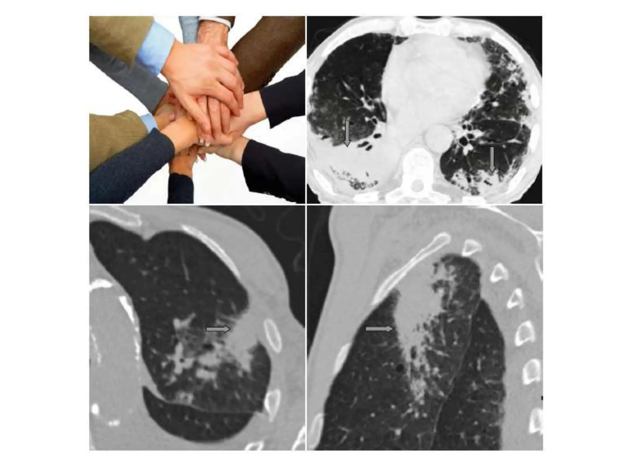 Chest signs spotters in xray andbct.pptx