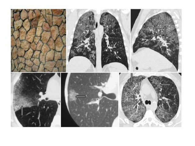 Chest signs spotters in xray andbct.pptx