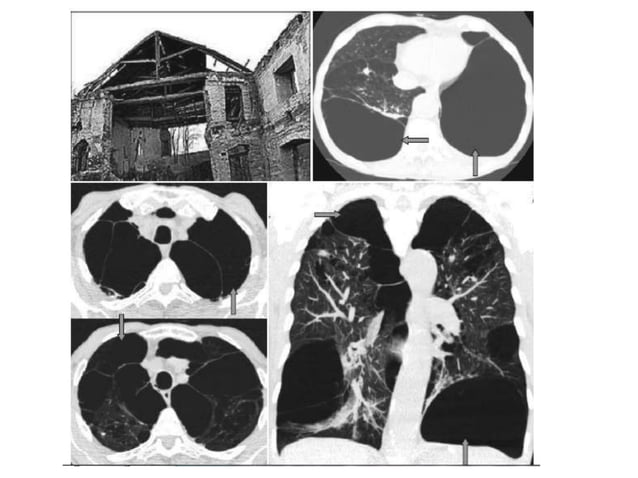 Chest signs spotters in xray andbct.pptx