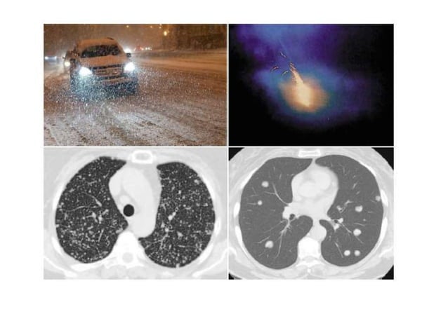 Chest signs spotters in xray andbct.pptx