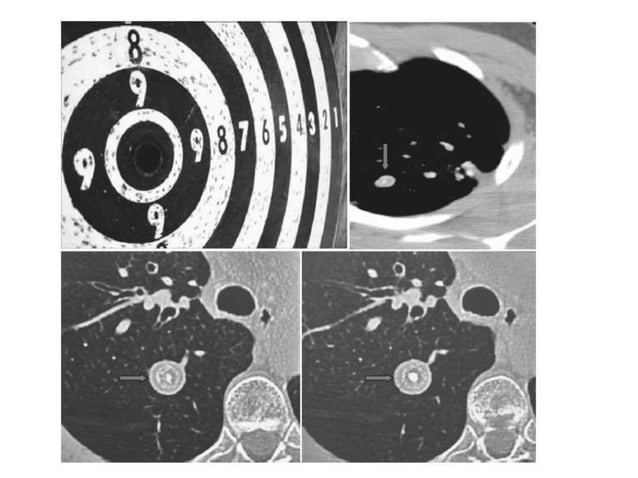 Chest signs spotters in xray andbct.pptx
