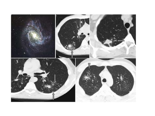 Chest signs spotters in xray andbct.pptx