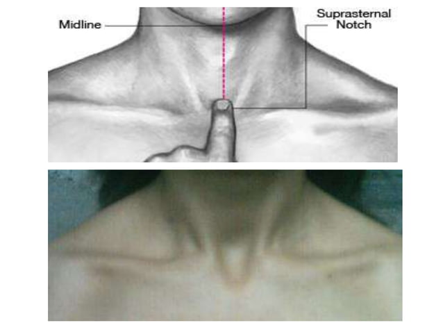 Chest Surface Anatomy-Lec 14.ppChest Surface Anatomy-Lec 14tx | PPT