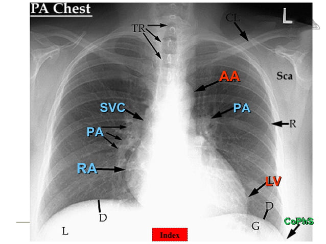 Chest surgical pathology &x rays | PPS | Lung and Respiratory Health ...