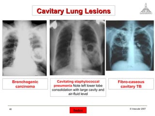 Chest surgical pathology &x rays | PPS