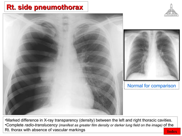 Chest surgical pathology &x rays | PPS | Lung and Respiratory Health ...