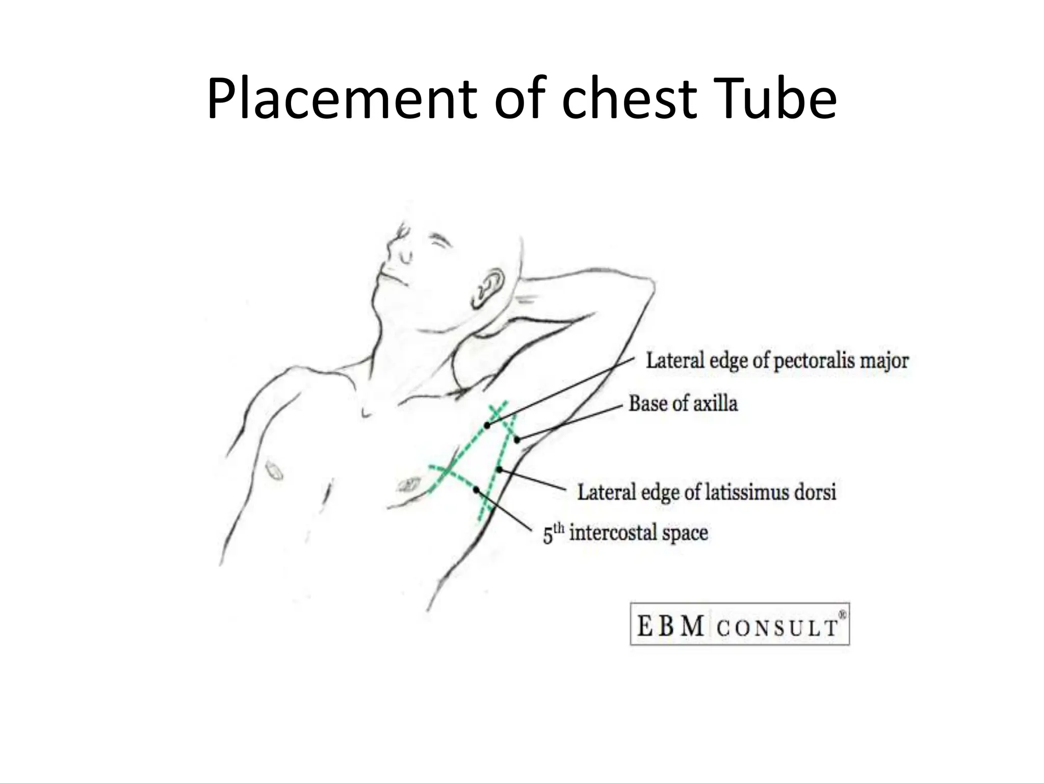 Mr. Ali Mushtaq Chest Thoracostomy.pptx. | PPT