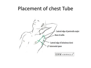 Mr. Ali Mushtaq Chest Thoracostomy.pptx. | PPTX