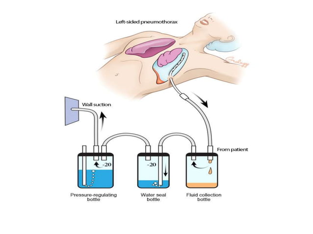 Mr. Ali Mushtaq Chest Thoracostomy.pptx. | PPT