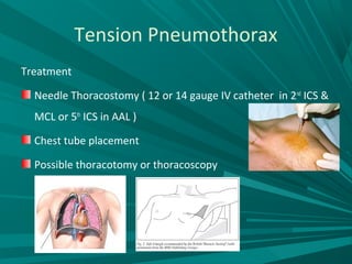 Chest trauma | PPT