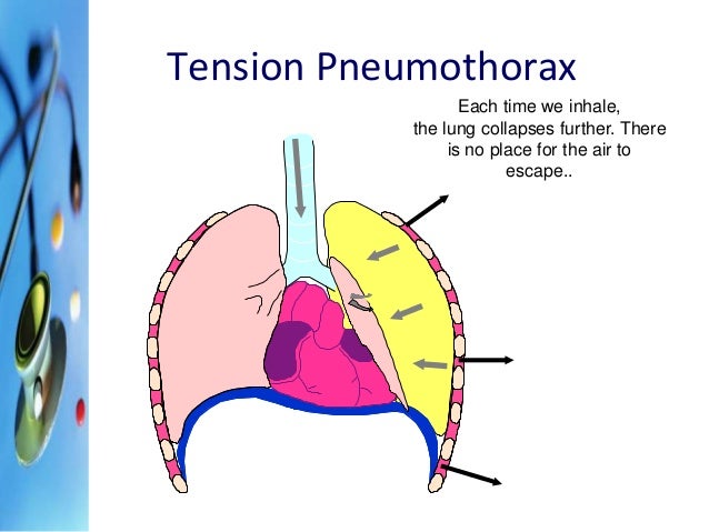 Safety Triangle For Chest Tube Tube Thoracostomy Dr Ellahi Bakhsh Routine Use Of Ultrasound