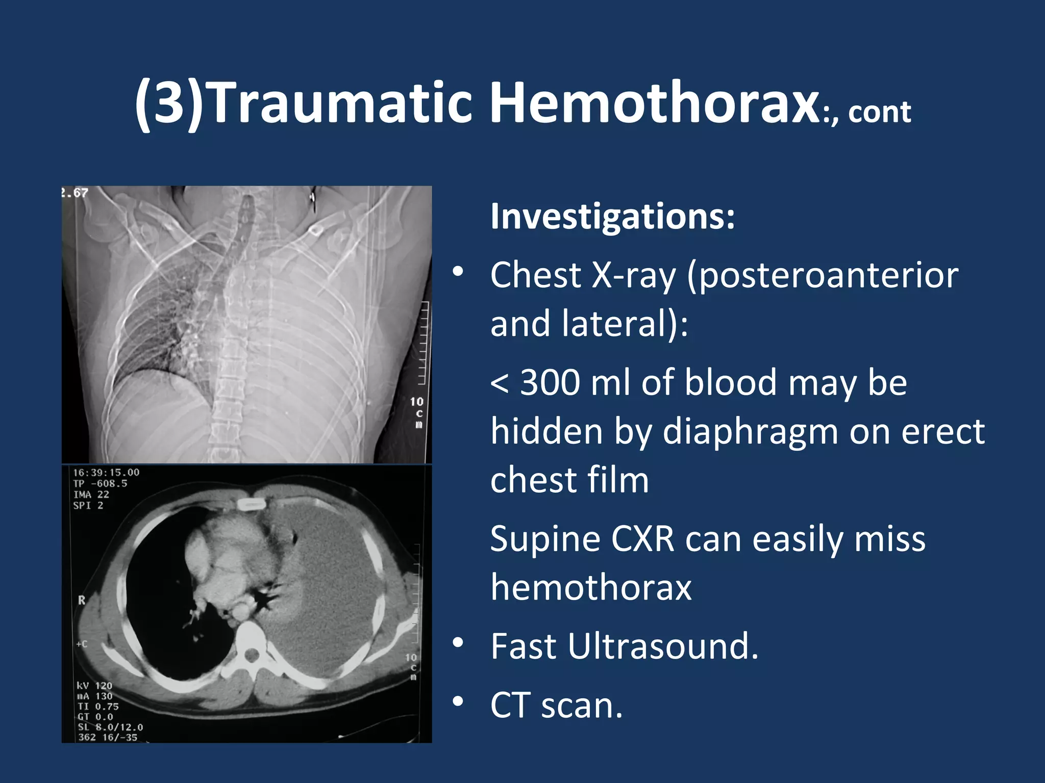 Chest Trauma | PPT