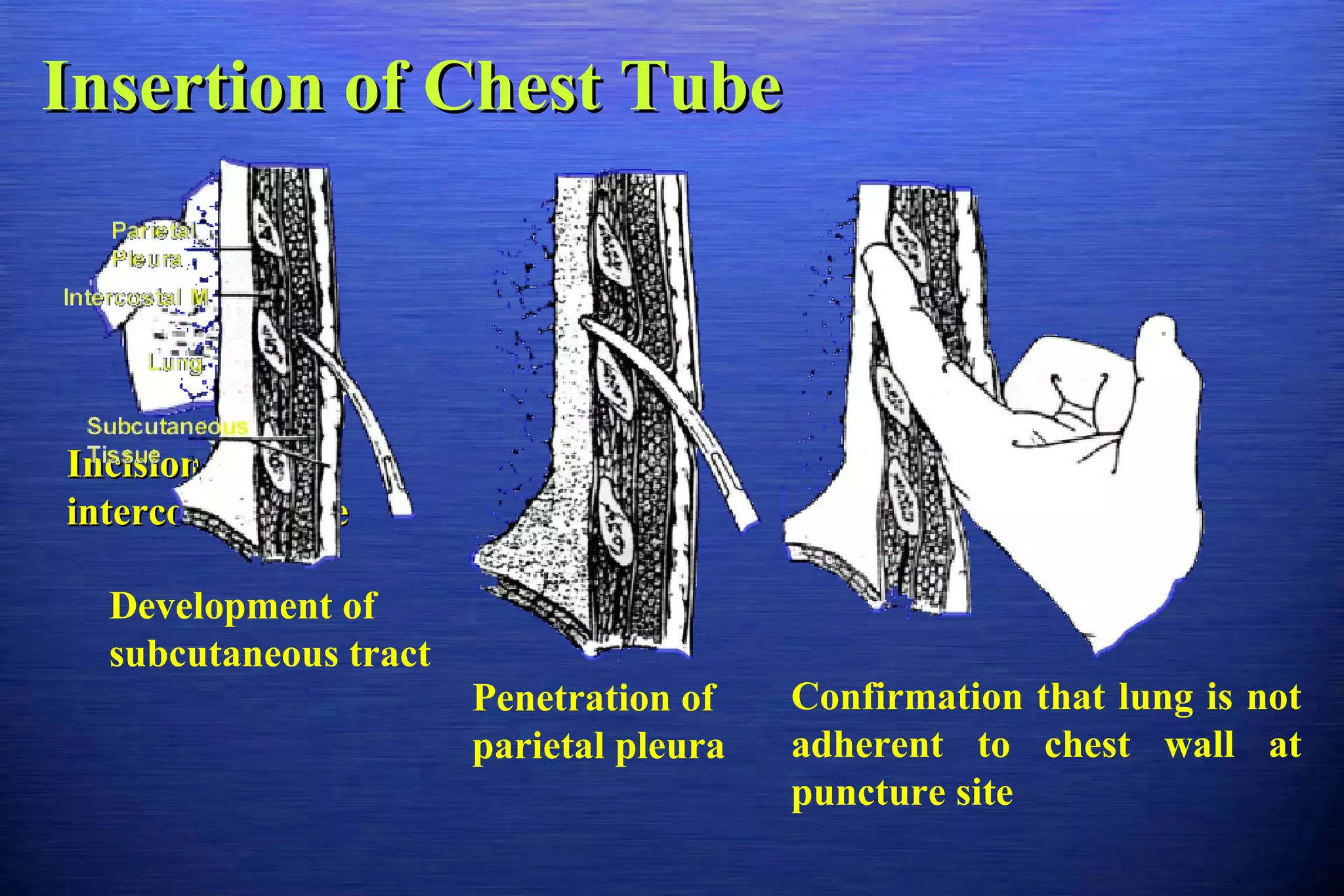 Chest trauma | PPT