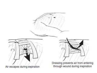Chest trauma | PPTX