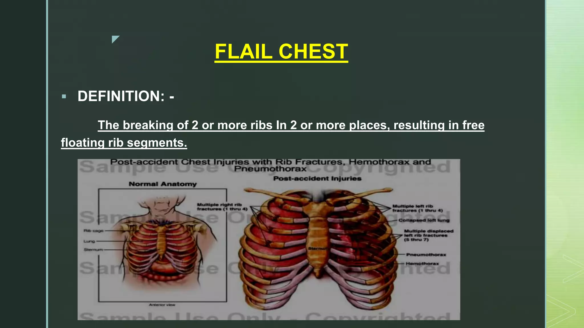 Chest trauma | PPTX | Death, Injury, or Military Conflict | Sensitive ...