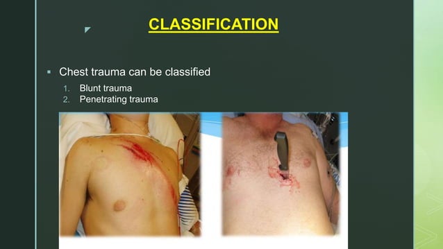 Chest trauma | PPT