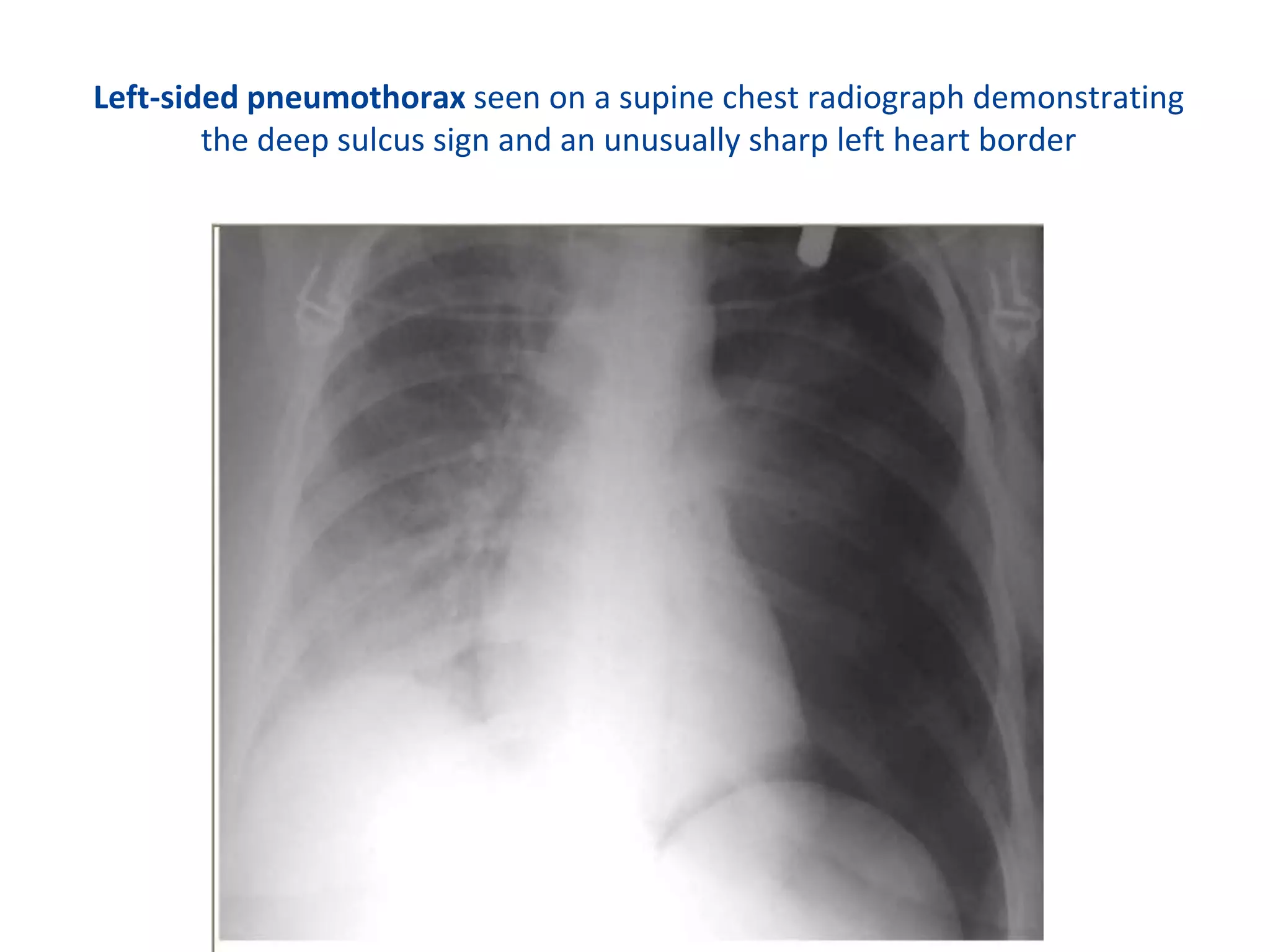 Chest trauma | PPT