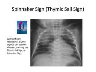 Chest trauma | PPT