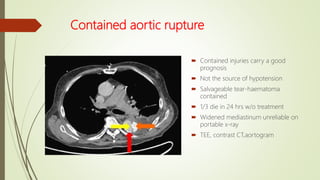 Chest trauma | PPT