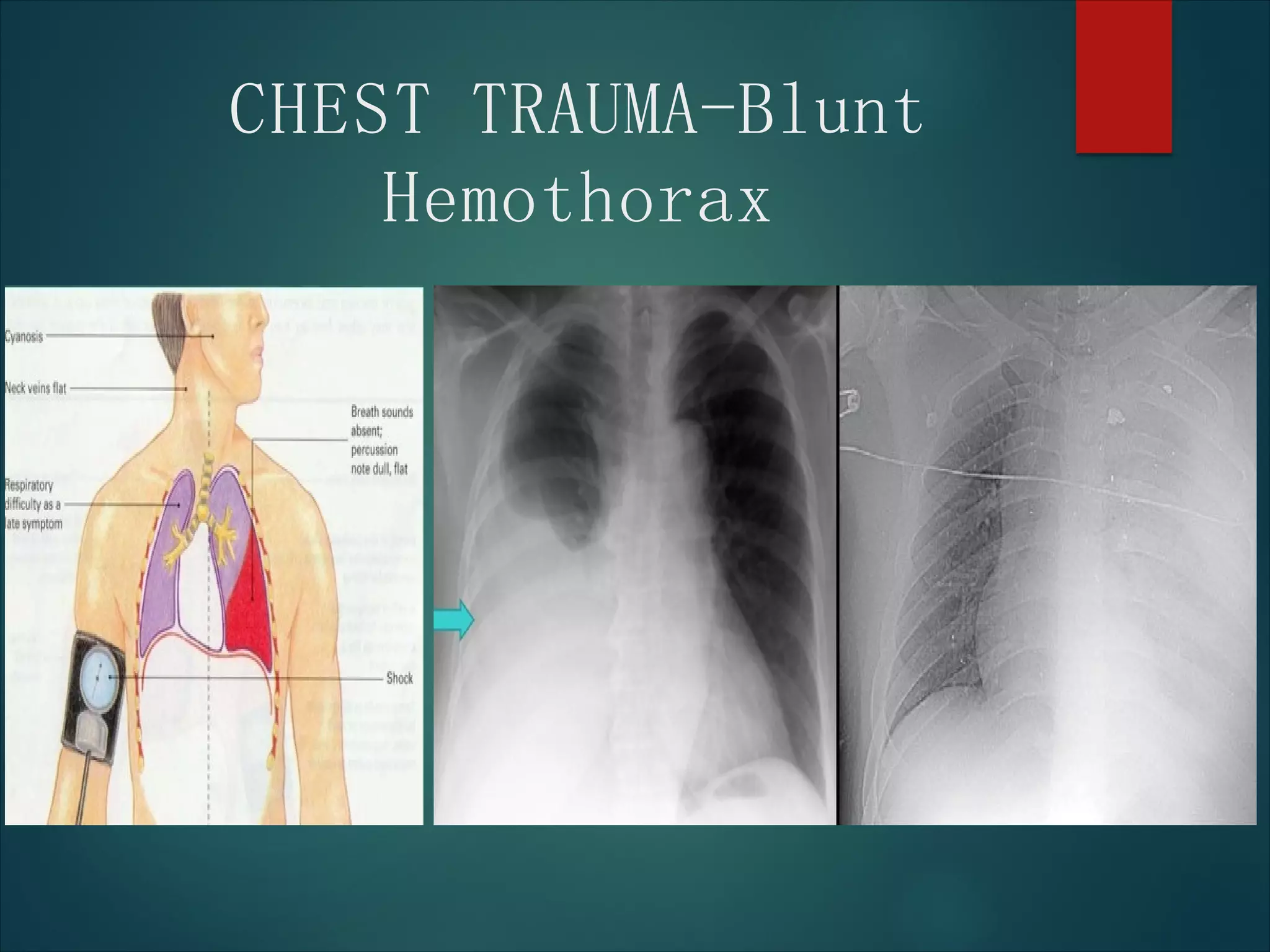 chest trauma.pdf